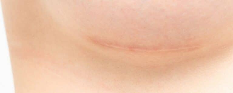 How to Reduce Scars After Breast Surgery | Enhance Medical Group